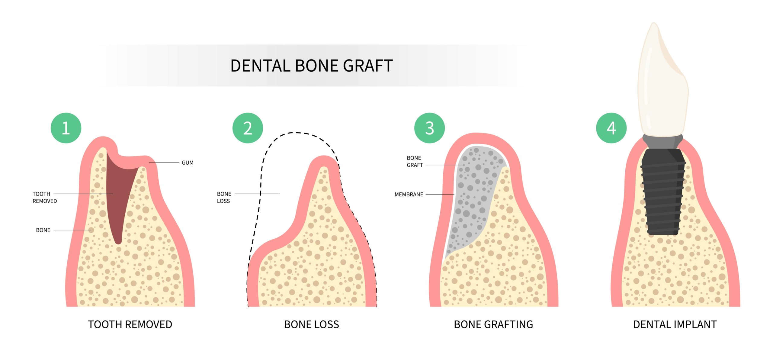 Bone Grafting in Hot Springs AR | Impact Oral Surgery