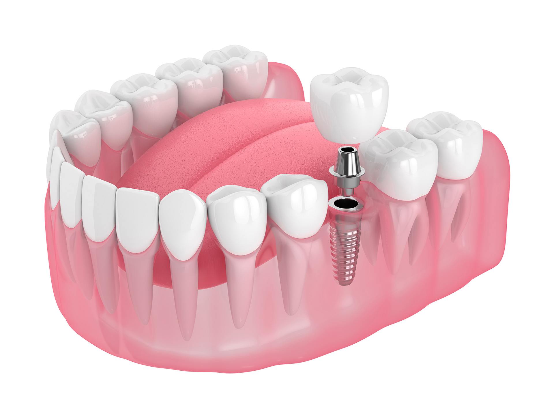 Dental Implants in El Dorado AR | Impact Oral Surgery